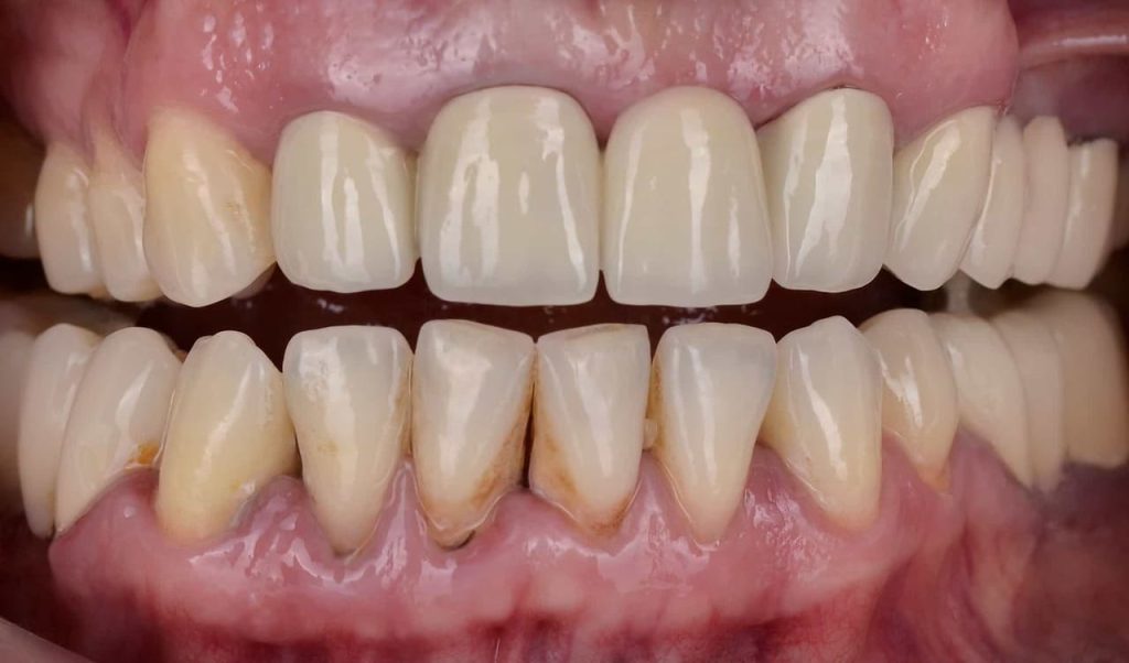 Tooth Extraction with Extensive Caries under Fused Porcelain Crown ...